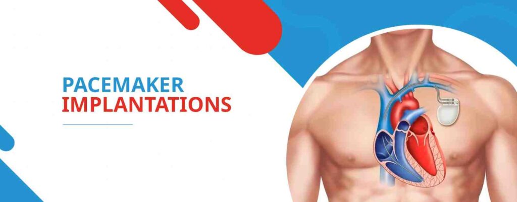 Pacemaker Implantation - Dr Soham Heart Clinic